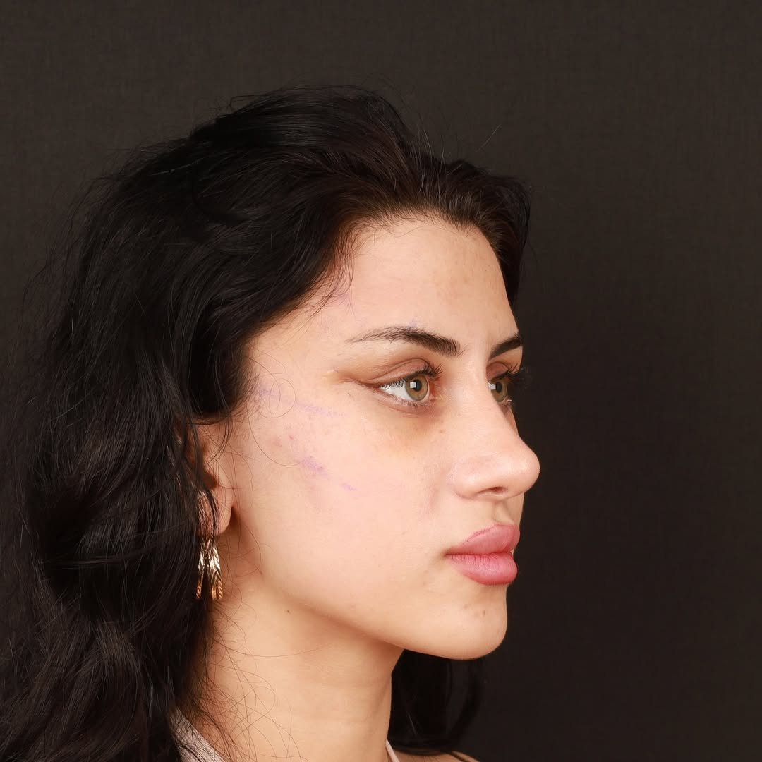 Fox Eye Surgery Before and After - Dr. Barış Altaylı