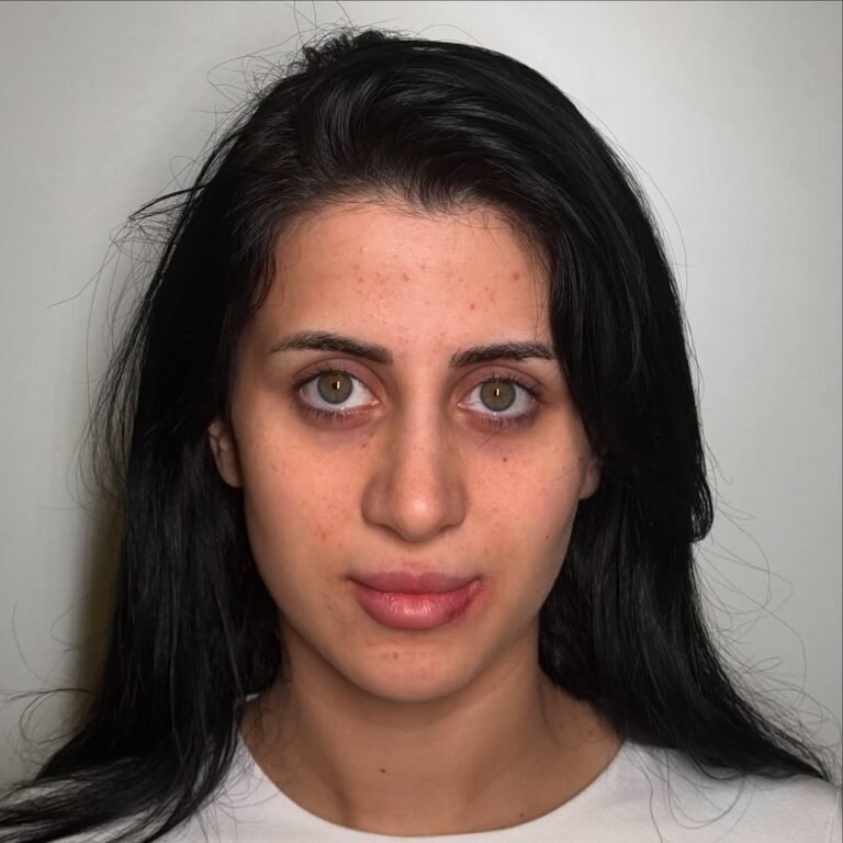 Fox Eye Surgery Before and After - Dr. Barış Altaylı