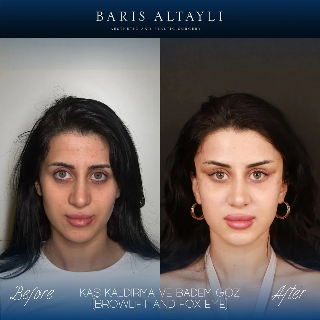 Fox Eye Surgery Before and After - Dr. Barış Altaylı